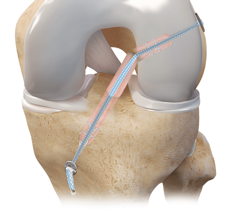 Arthrex Hamstring Autograft Acl Reconstruction
